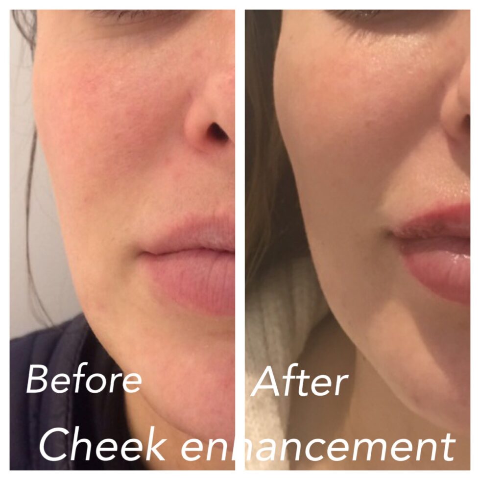 Dermal Fillers - M Clinic London