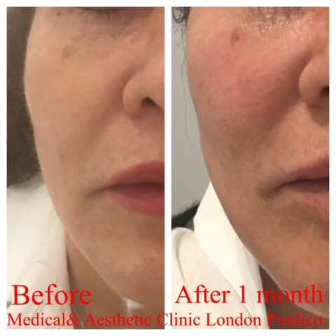 Profhilo - M Clinic London