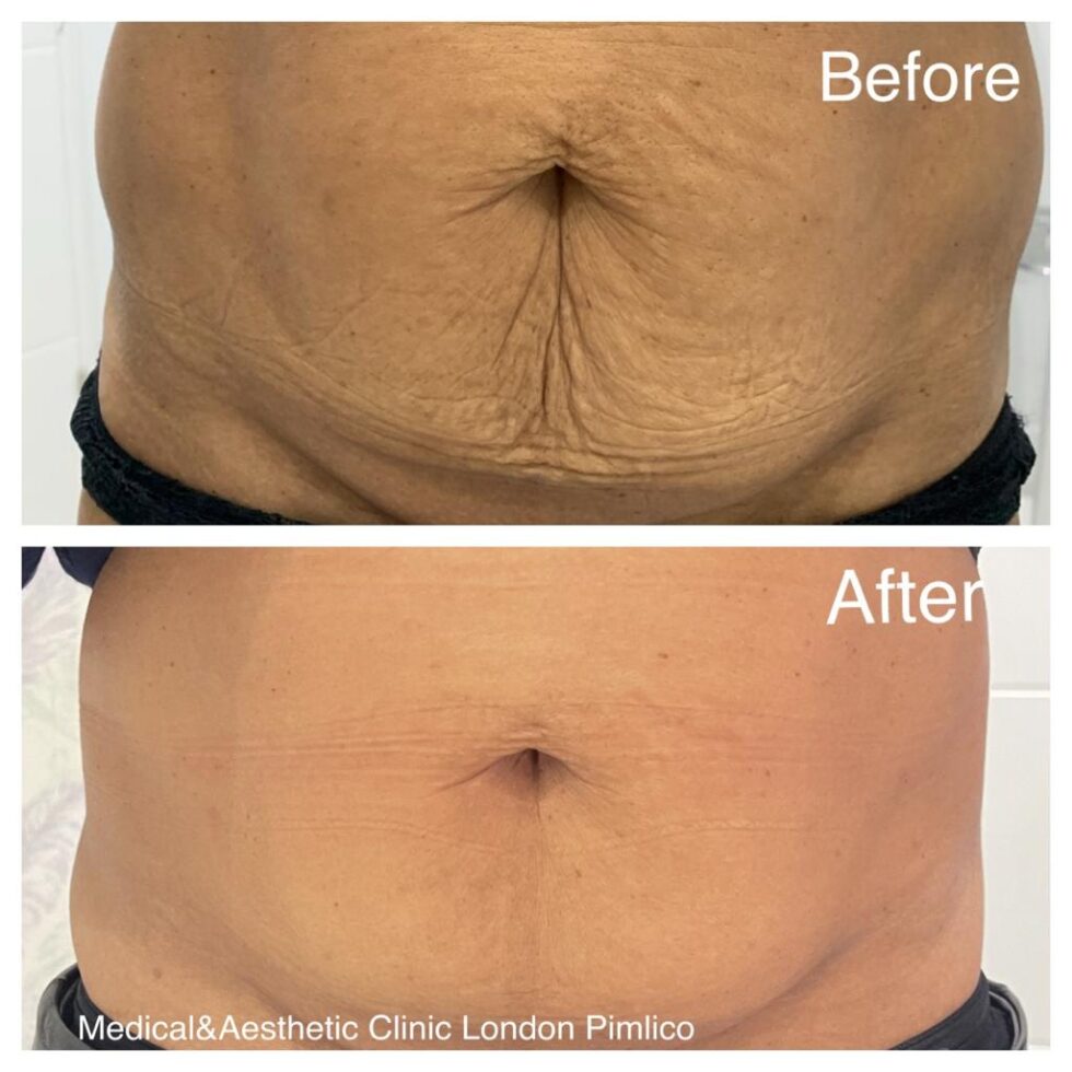 Lipotherapy - M Clinic London
