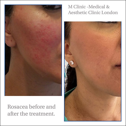 Rosacea - M Clinic London